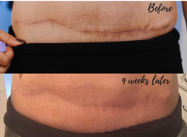 5 1/2 Month Post-Surgery Update + Embrace Active Scar Defense Review